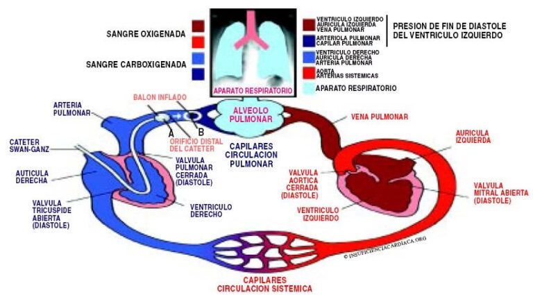 Presión Capilar Pulmonar: Clave Diagnóstica Cardíaca | CAPELLO